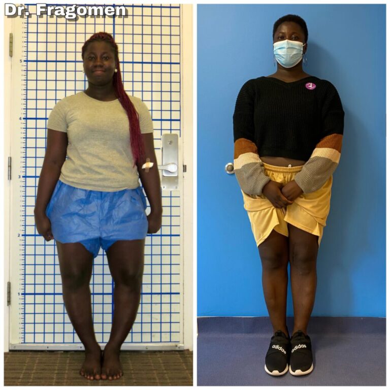Before and After Images – Limb Lengthening