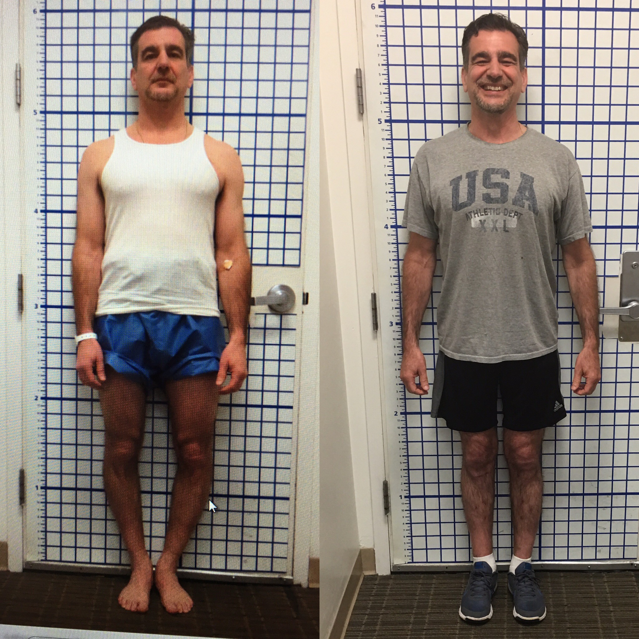 Bowleg Before and After Photos – Limb Lengthening