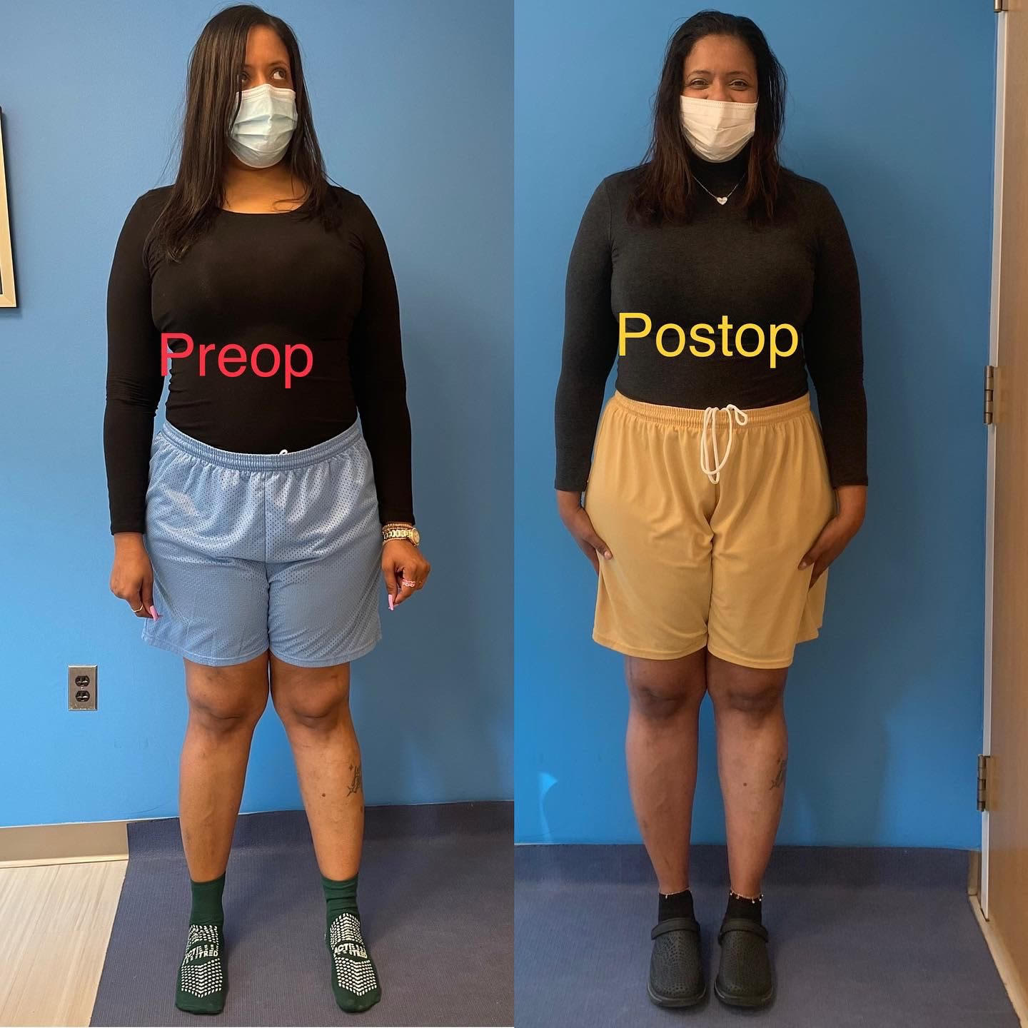 Knock Knee Deformity Before and After Photos – Limb Lengthening