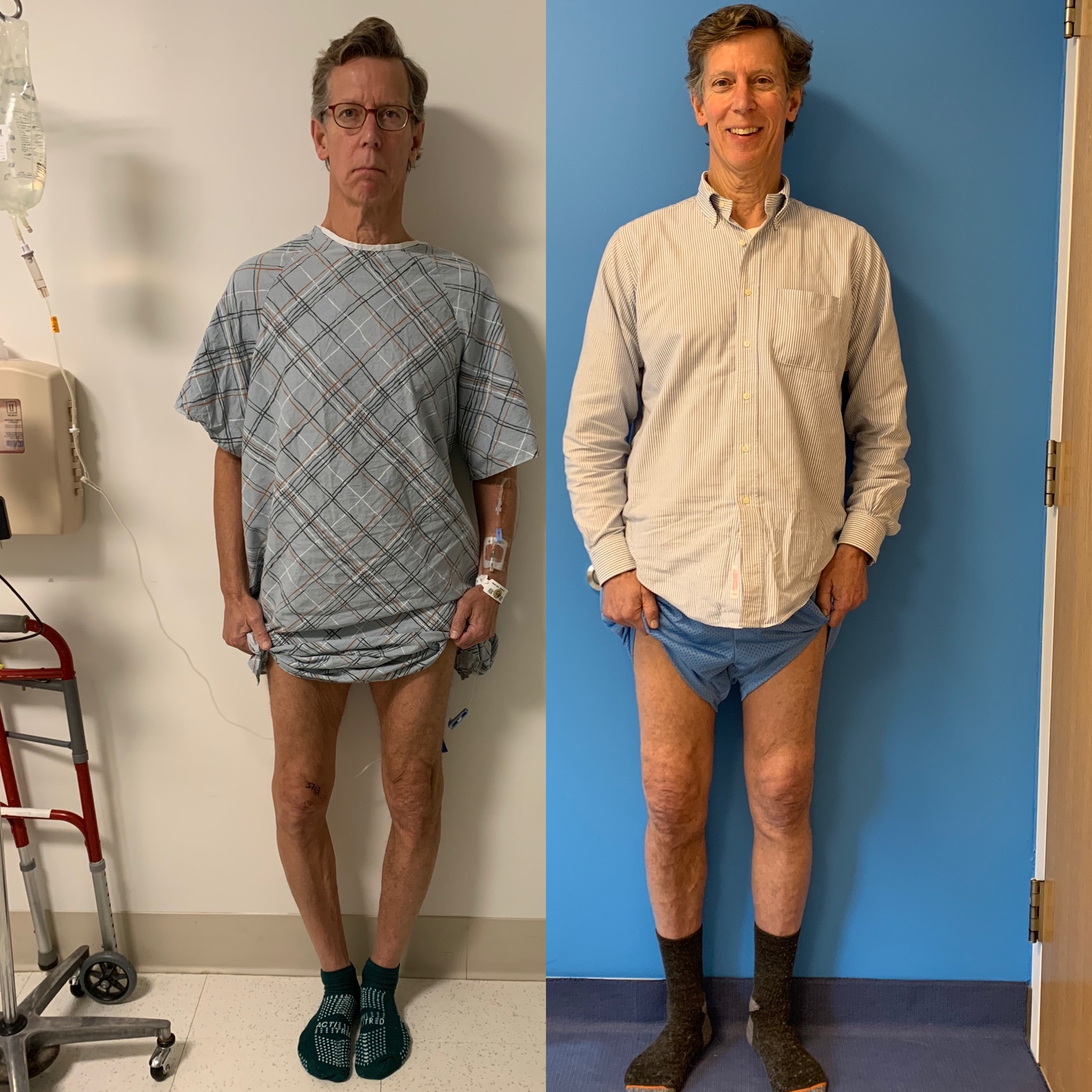 Bowleg Before and After Photos – Limb Lengthening