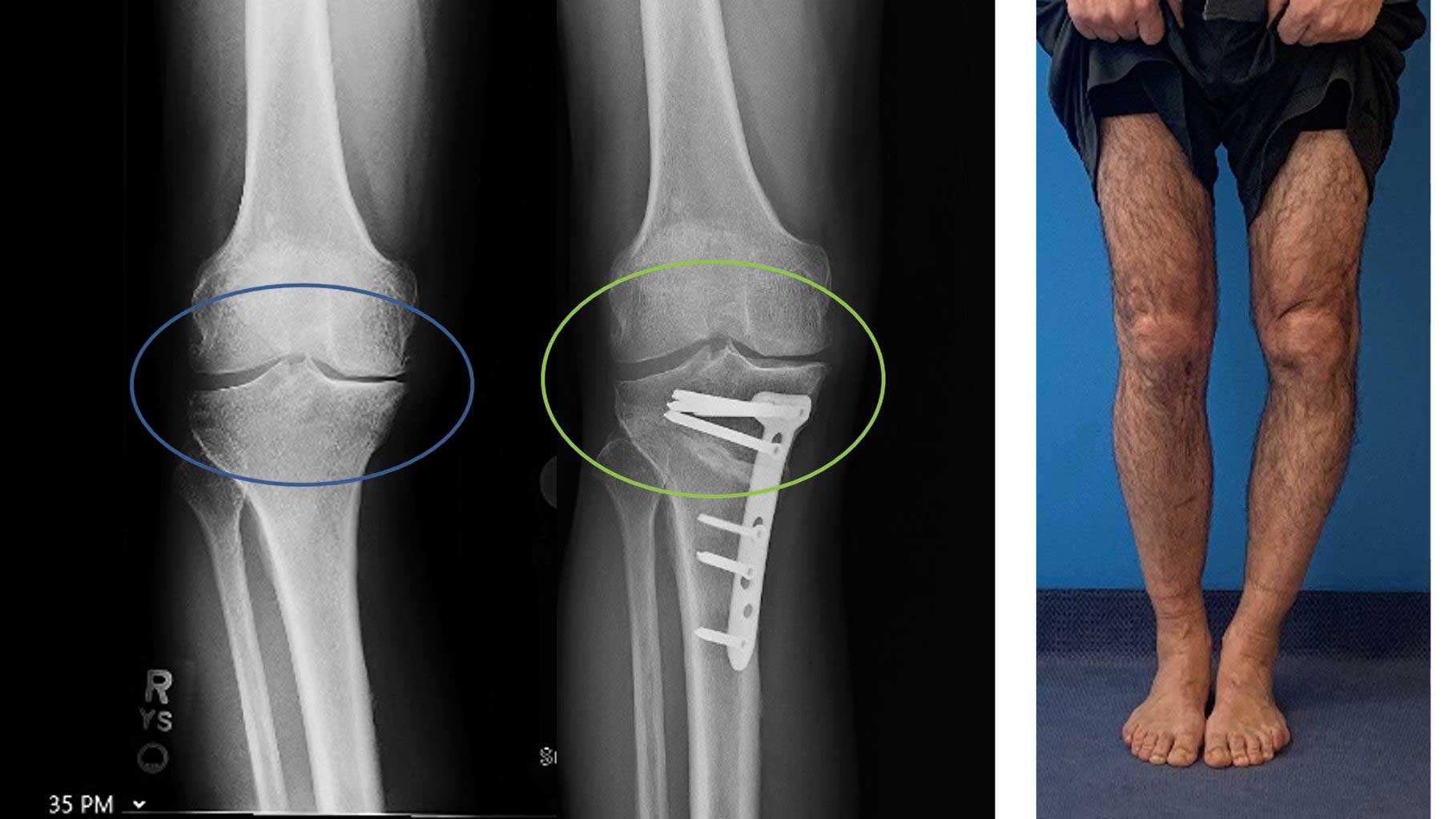Bowleg Overview – Limb Lengthening
