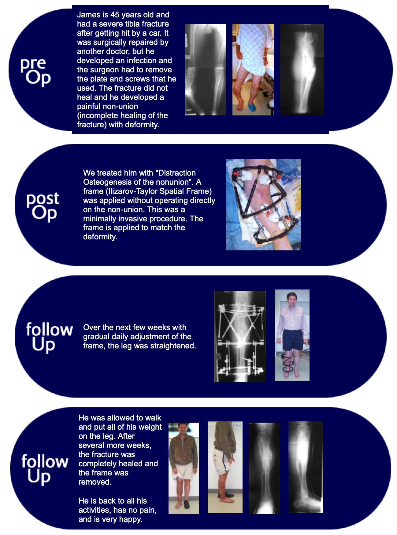 Distraction of Tibial Non-Union - Limb Lengthening