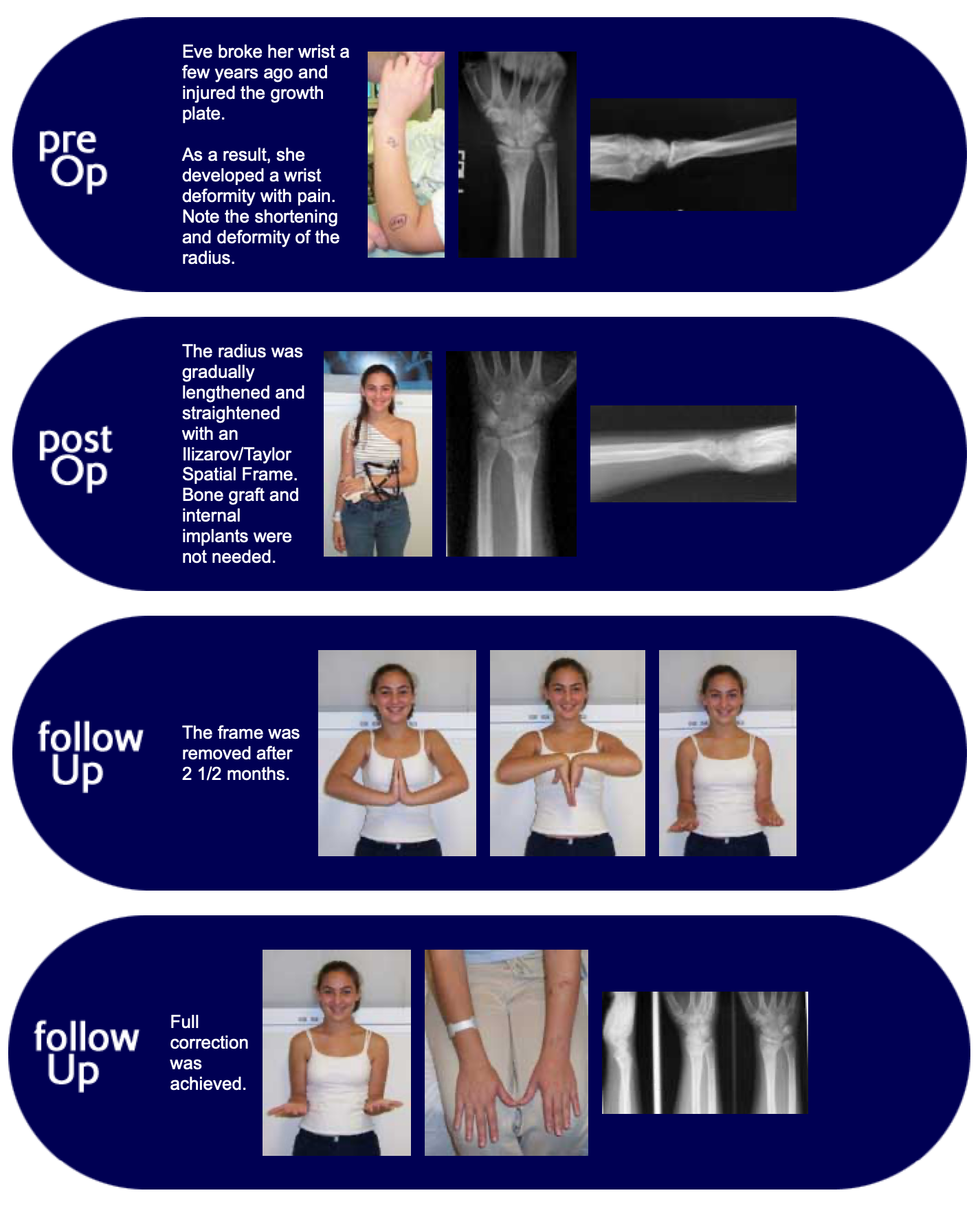Radius Lengthening in Child – Limb Lengthening