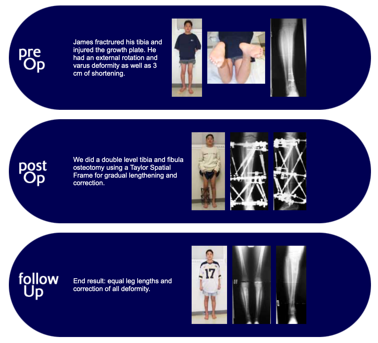 Pediatric Tibia Lengthening and Correction - Limb Lengthening