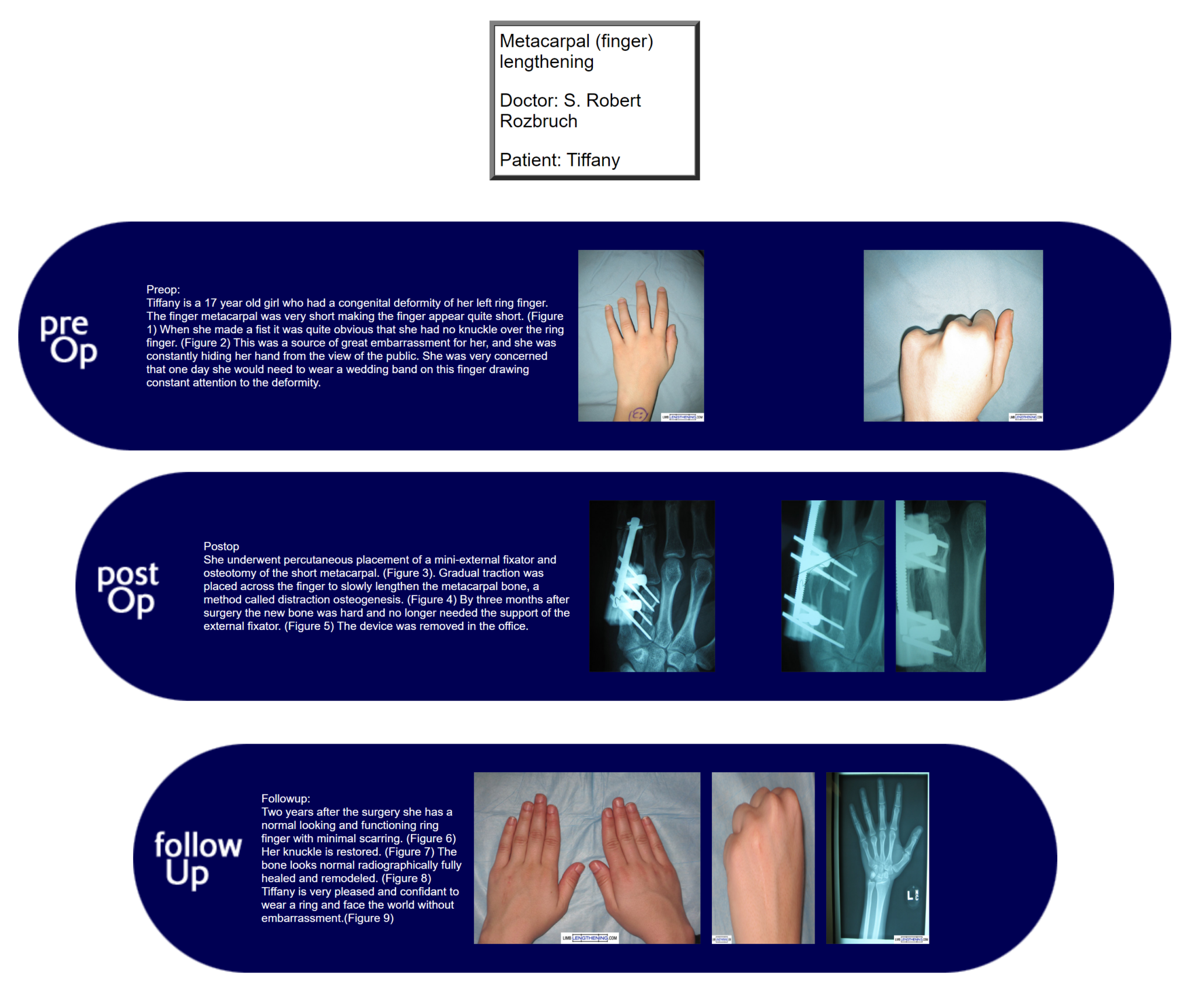 Case History #68 Metacarpal (Finger) Lengthening – Limb Lengthening