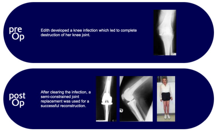Total Knee Replacements Limb Lengthening