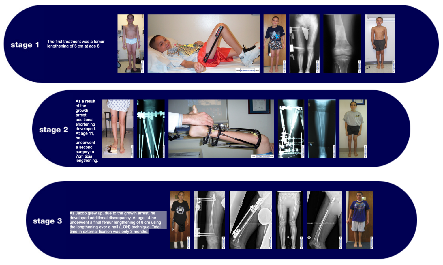 Femur Lengthening Over a Nail – Limb Lengthening