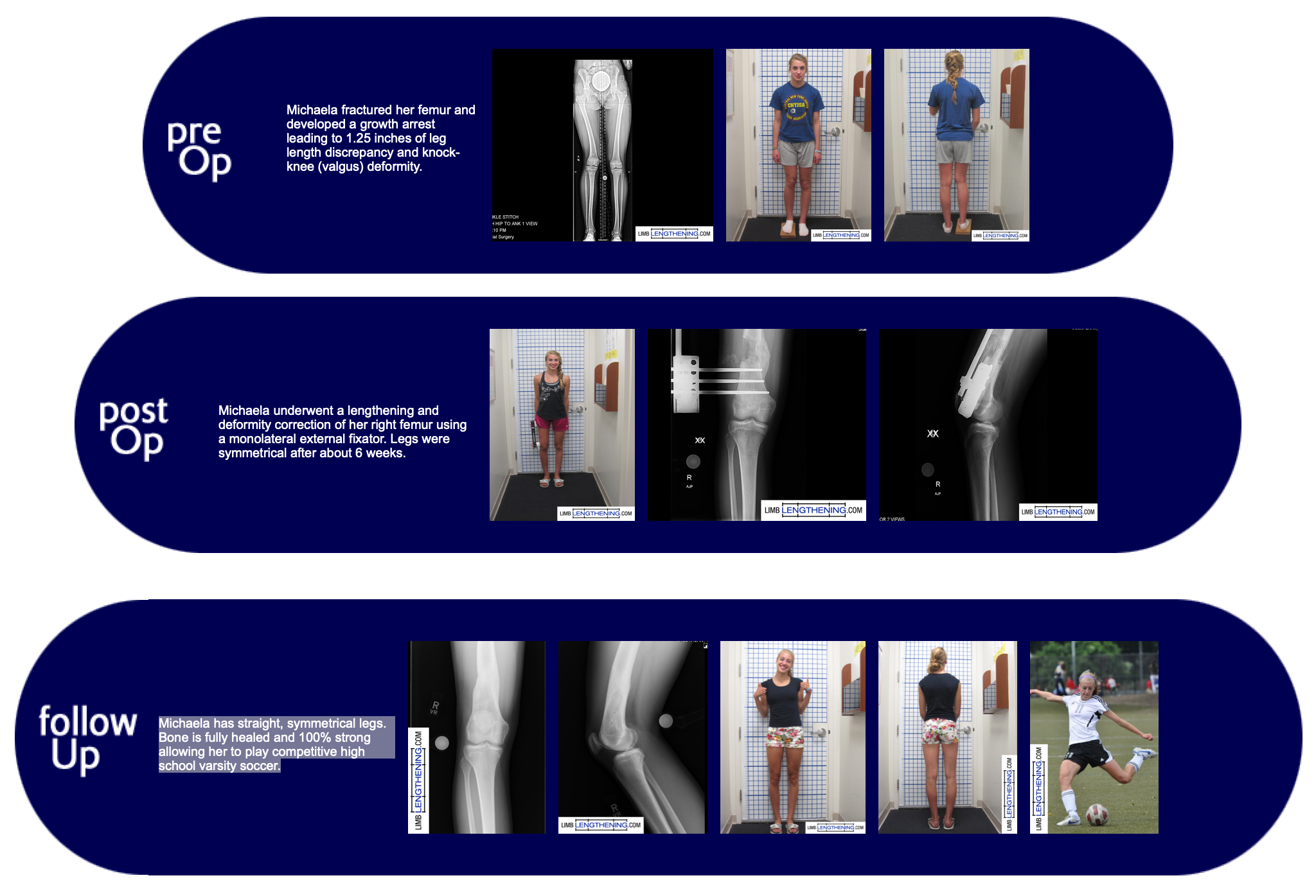 Deformity Correction After Growth Arrest – Limb Lengthening