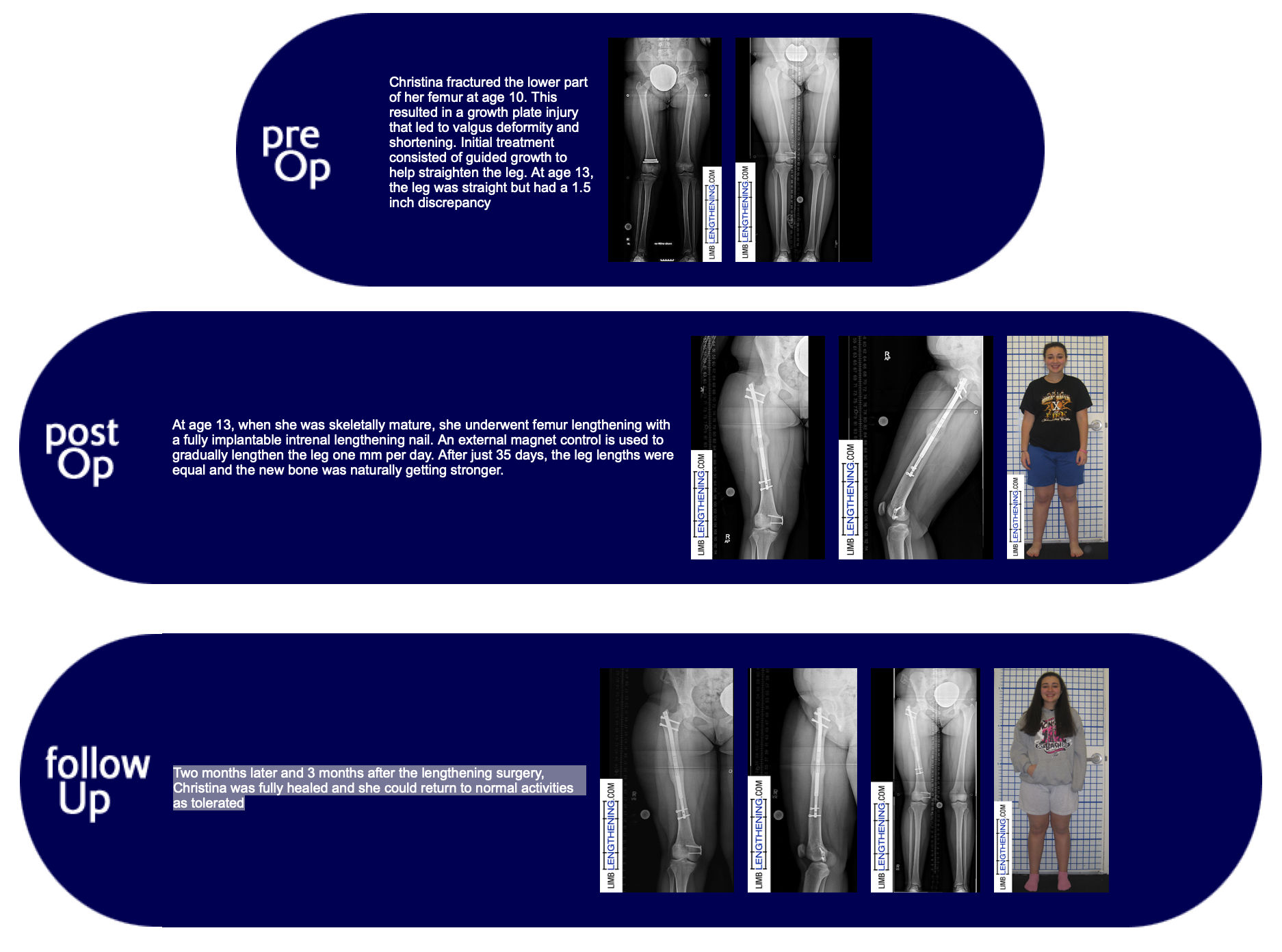 Femur Lengthening with Internal Nail – Limb Lengthening