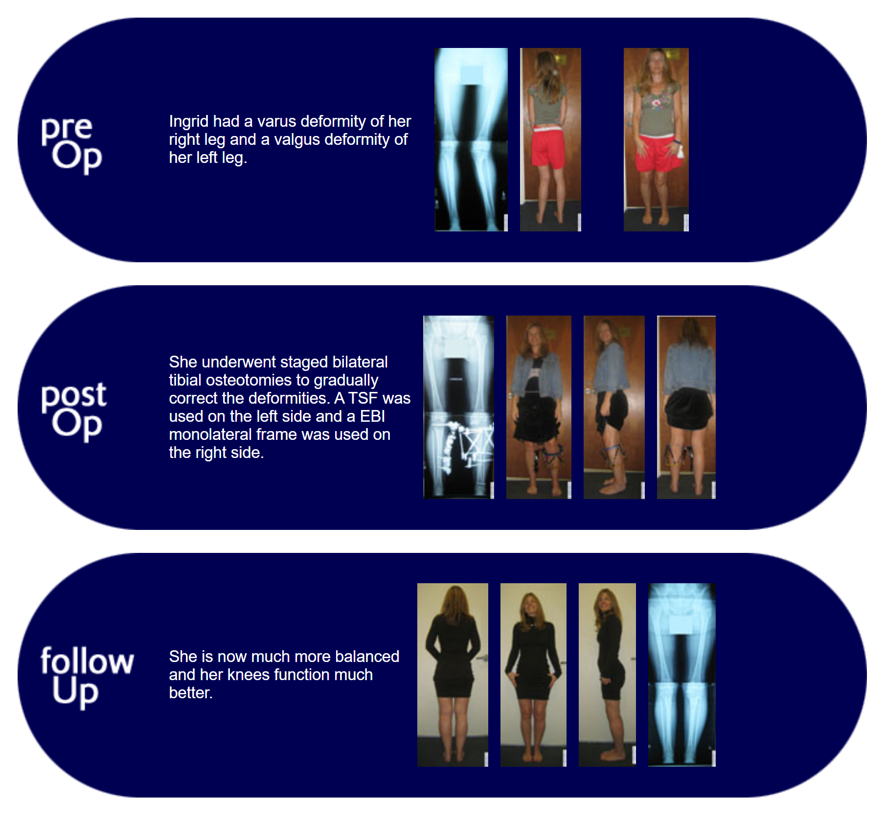 Correction of Bilateral Leg Deformity – Limb Lengthening