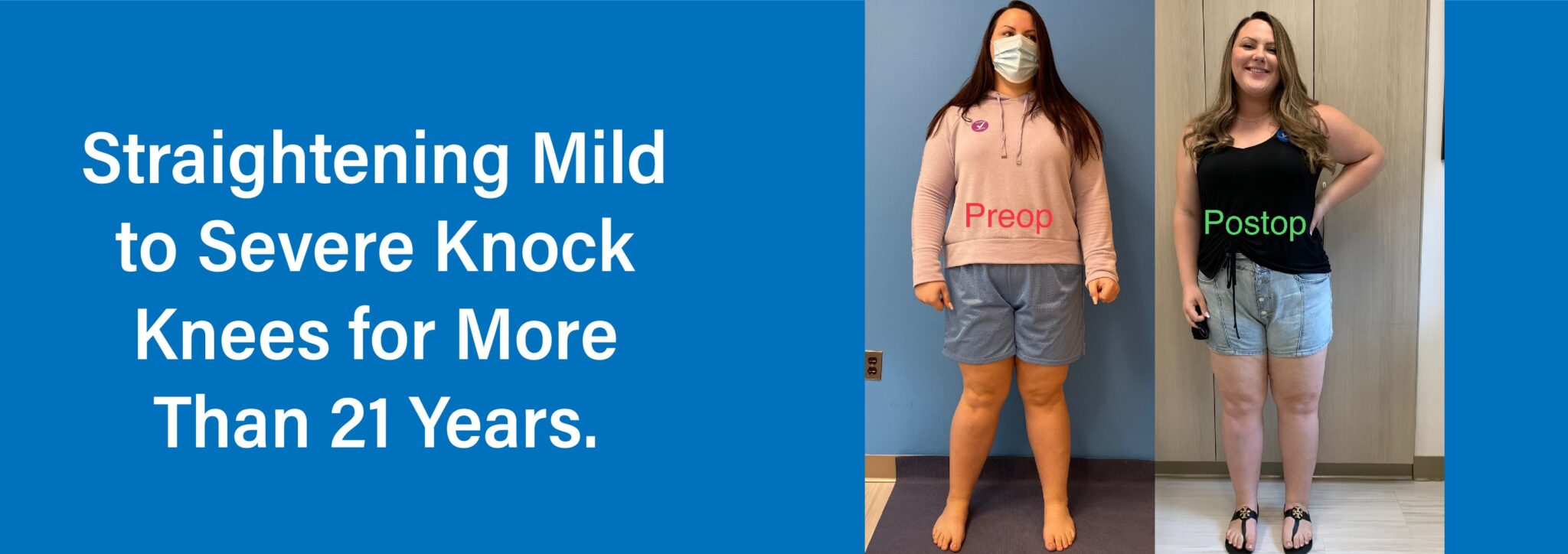 Knock Knee Condition Overview – Limb Lengthening