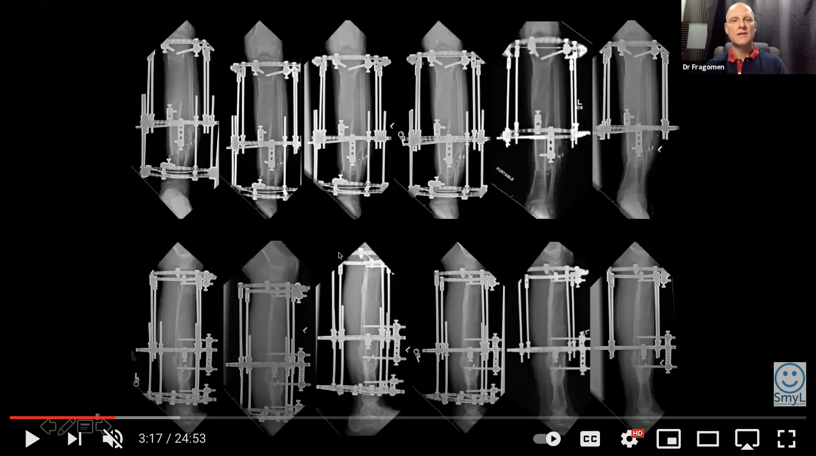 Bone Tumors - Symptoms, Treatments and Outcomes for Bone Tumors - Limb ...